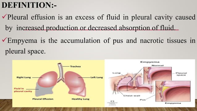 Pleural effusion & empyema.pptx