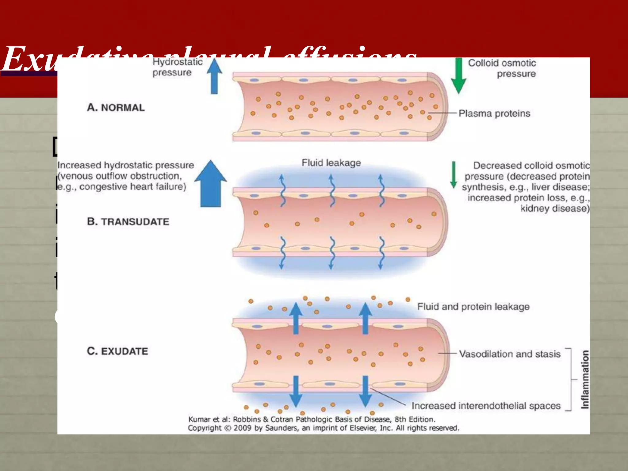 Pleural Effusion for Undergraduates | PPTX
