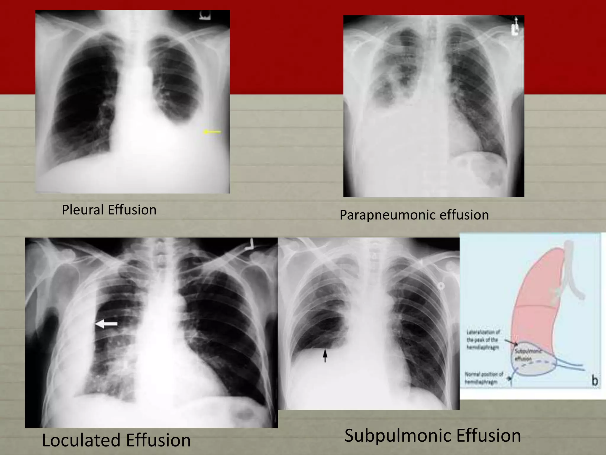 Pleural Effusion for Undergraduates | PPTX