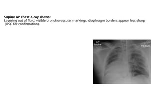 Pleural effusion and pleura final...pptx