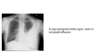 Pleural effusion and pleura final...pptx