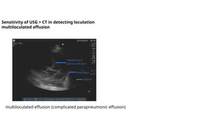 Pleural effusion and pleura final...pptx