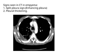 Pleural effusion and pleura final...pptx