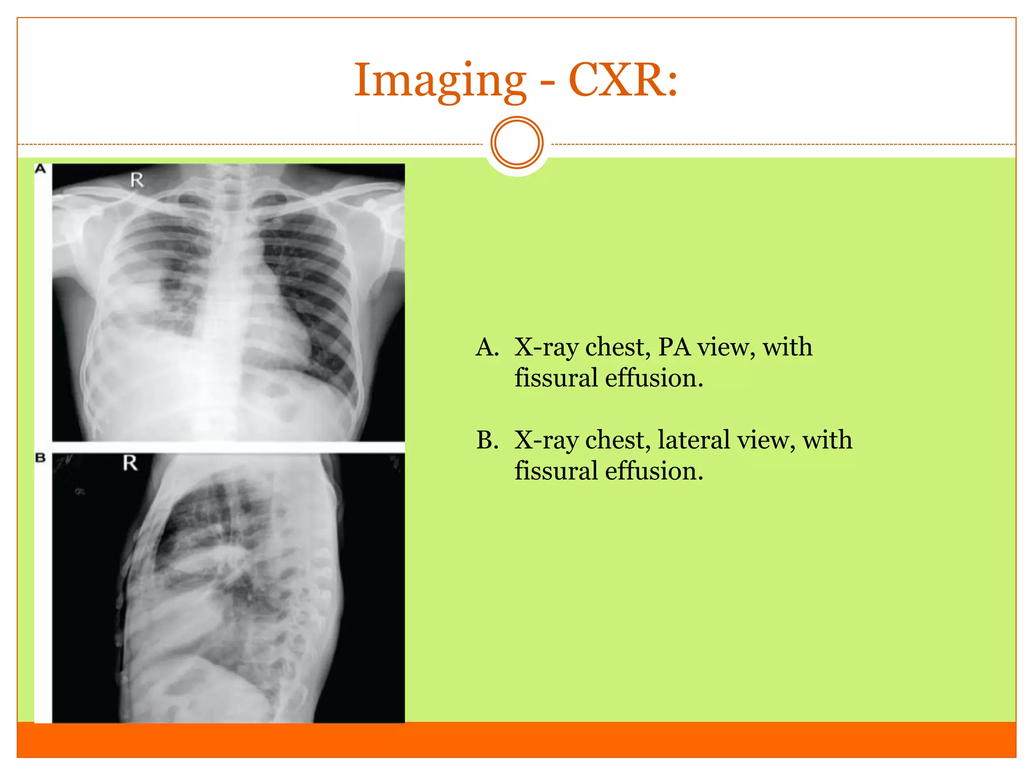 Pleural effusion ppt | PPTX