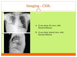Pleural effusion ppt | PPTX