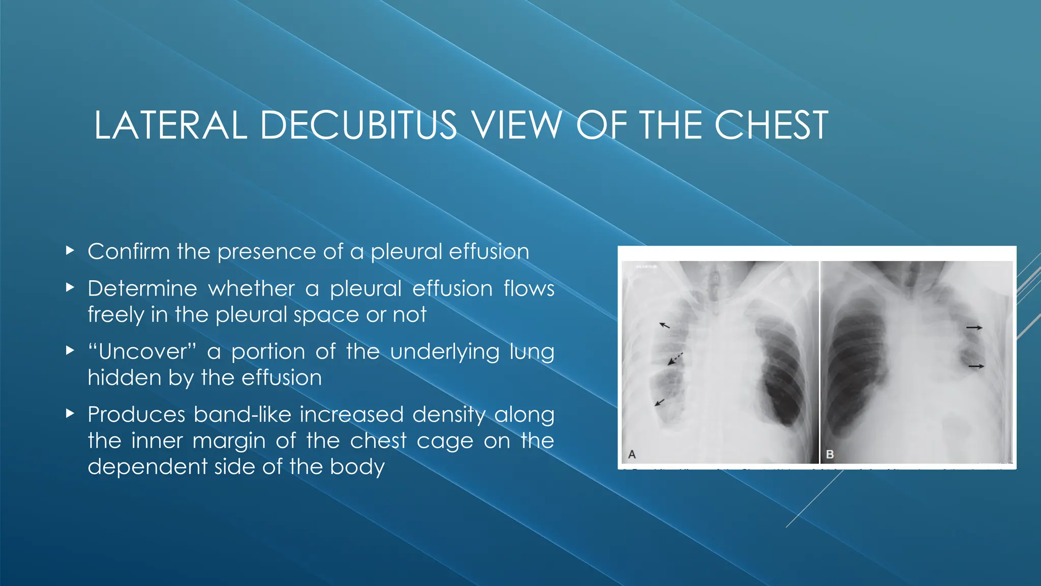 Pleural effusion radiology and anatomy.pptx