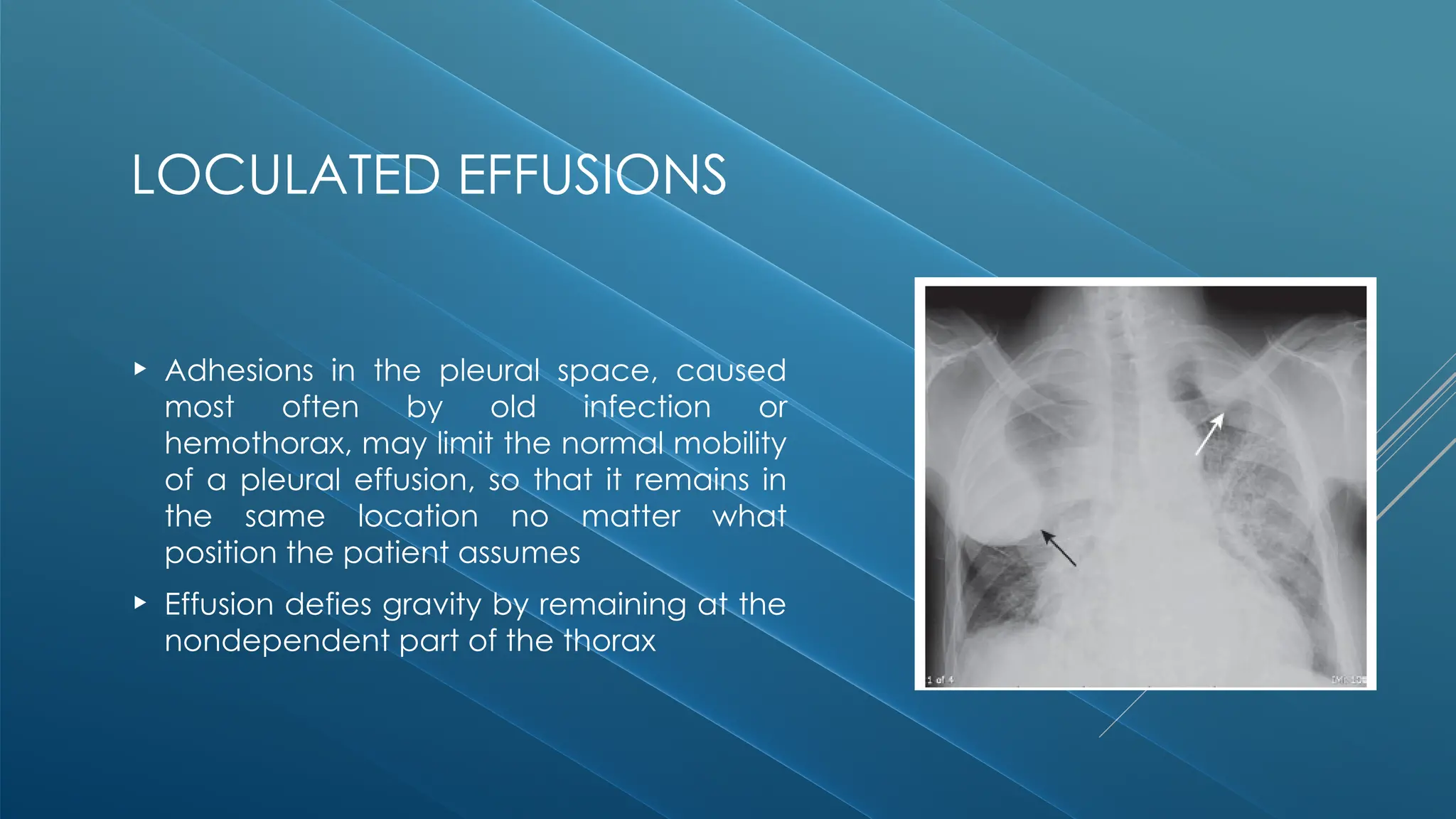 Pleural effusion radiology and anatomy.pptx