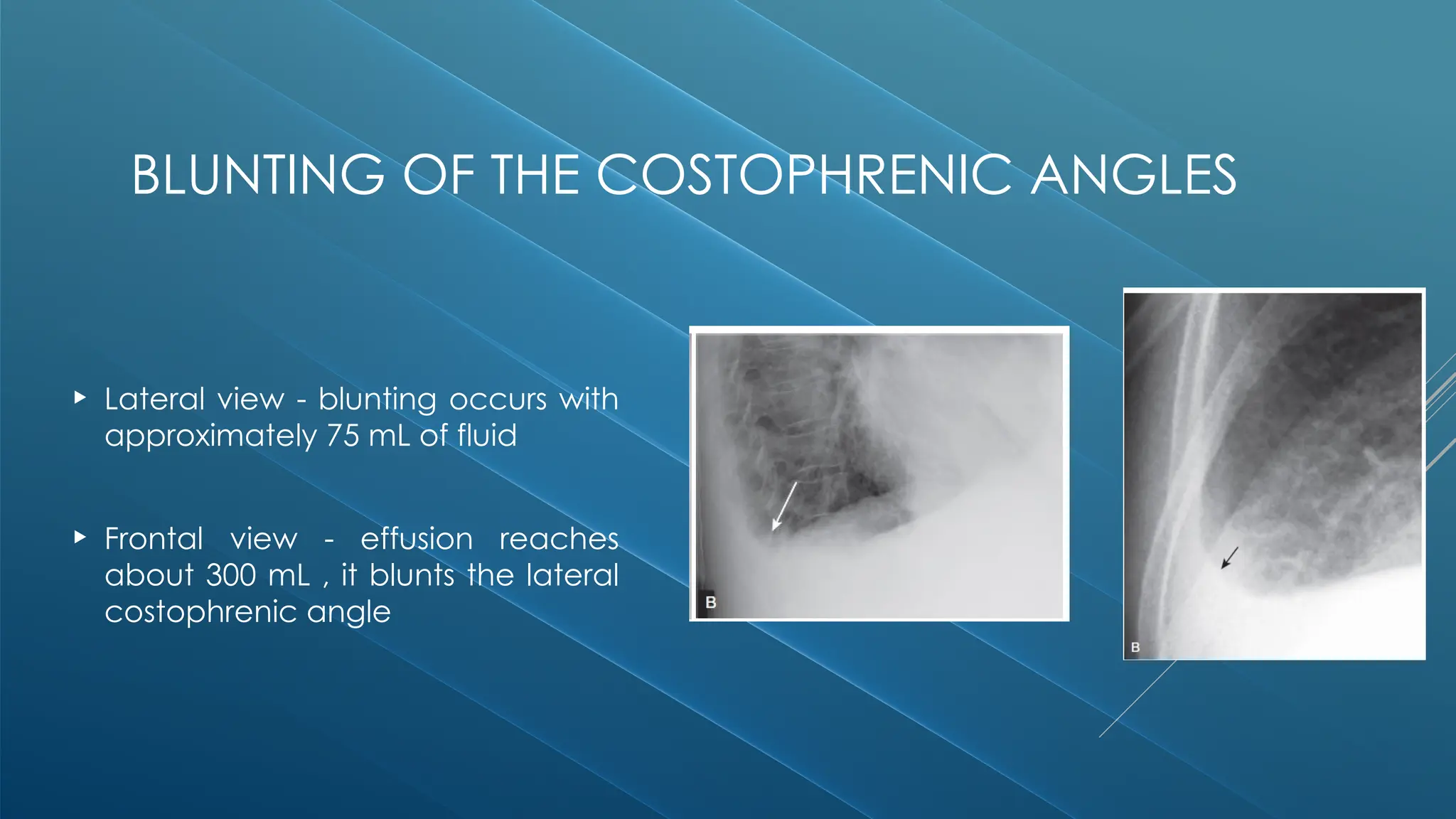 Pleural effusion radiology and anatomy.pptx