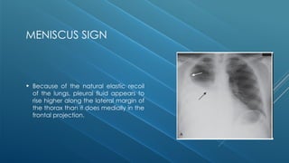 Pleural effusion radiology and anatomy.pptx