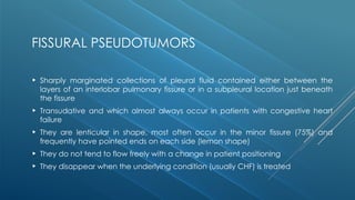Pleural effusion radiology and anatomy.pptx