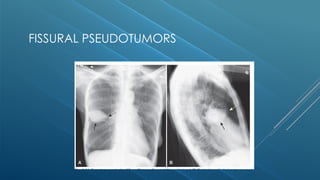 Pleural effusion radiology and anatomy.pptx