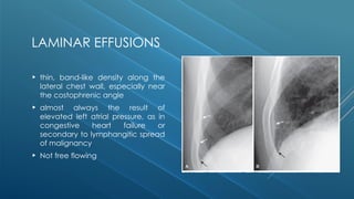 Pleural effusion radiology and anatomy.pptx