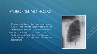 Pleural effusion radiology and anatomy.pptx