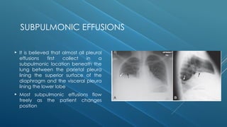 Pleural effusion radiology and anatomy.pptx