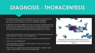 LCP Pleural Effusion Group Report March 12 2014 | PPTX
