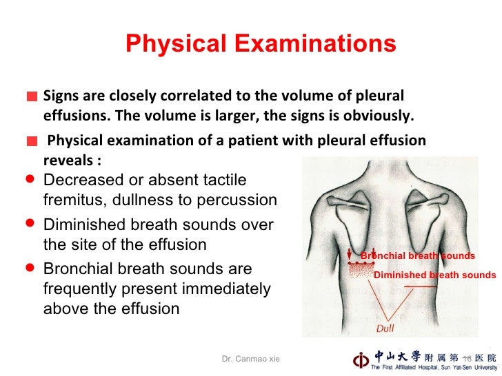 Pleural Effusions