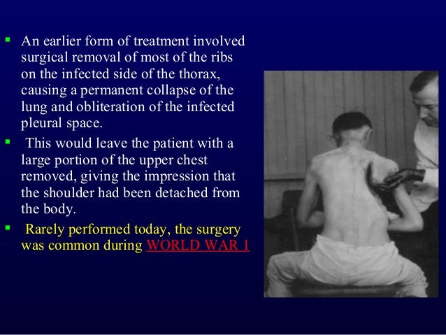 Pleural empyema dr.tinku joseph