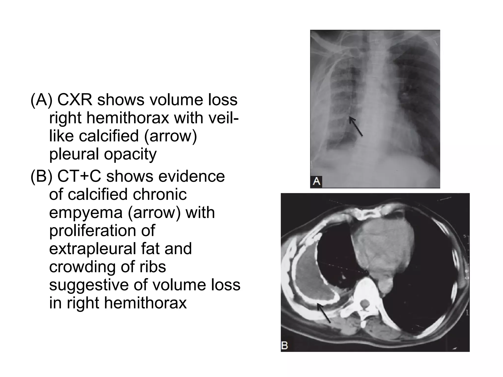 Pleural lesions | PPT