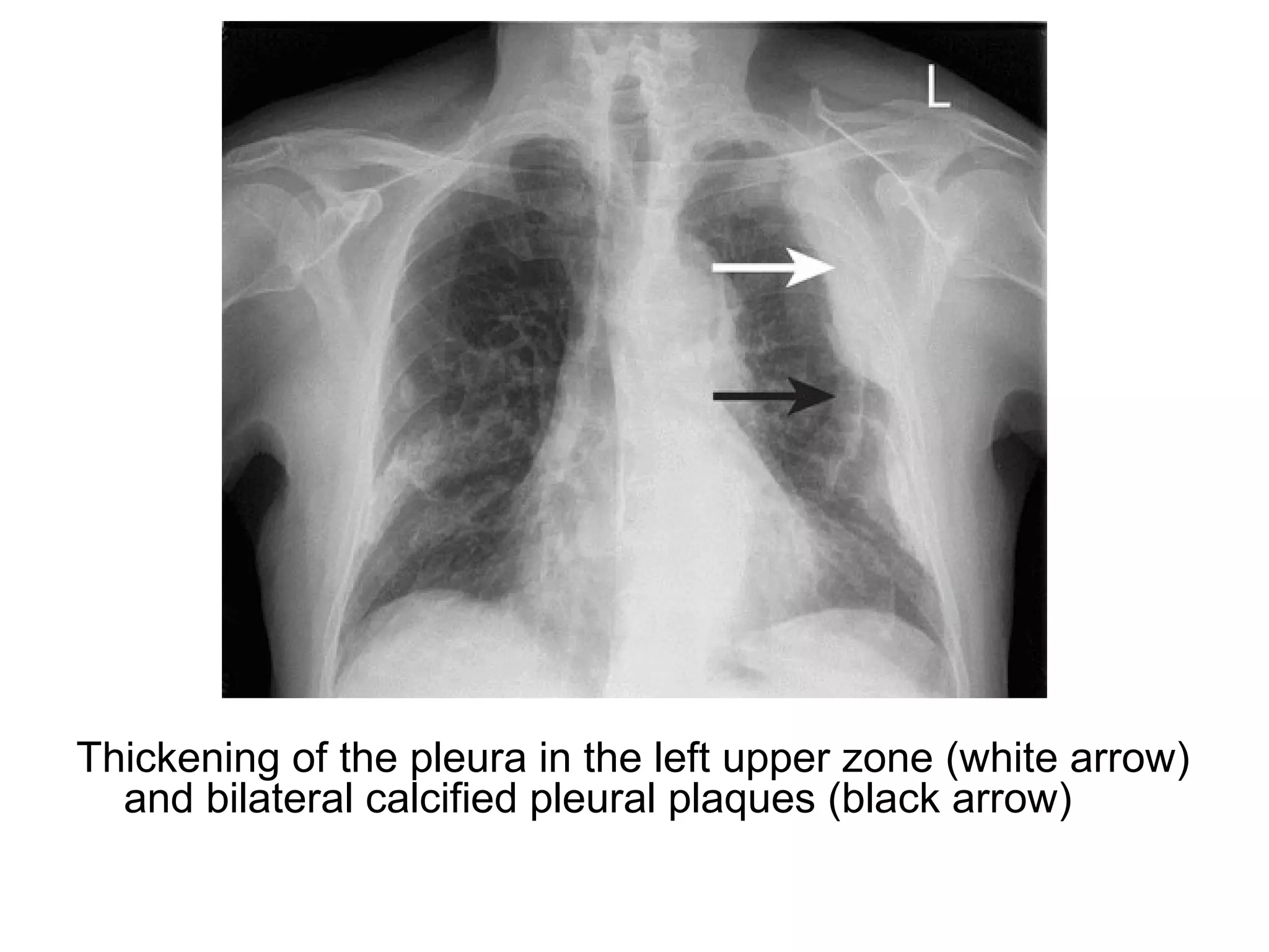 Pleural lesions | PPT
