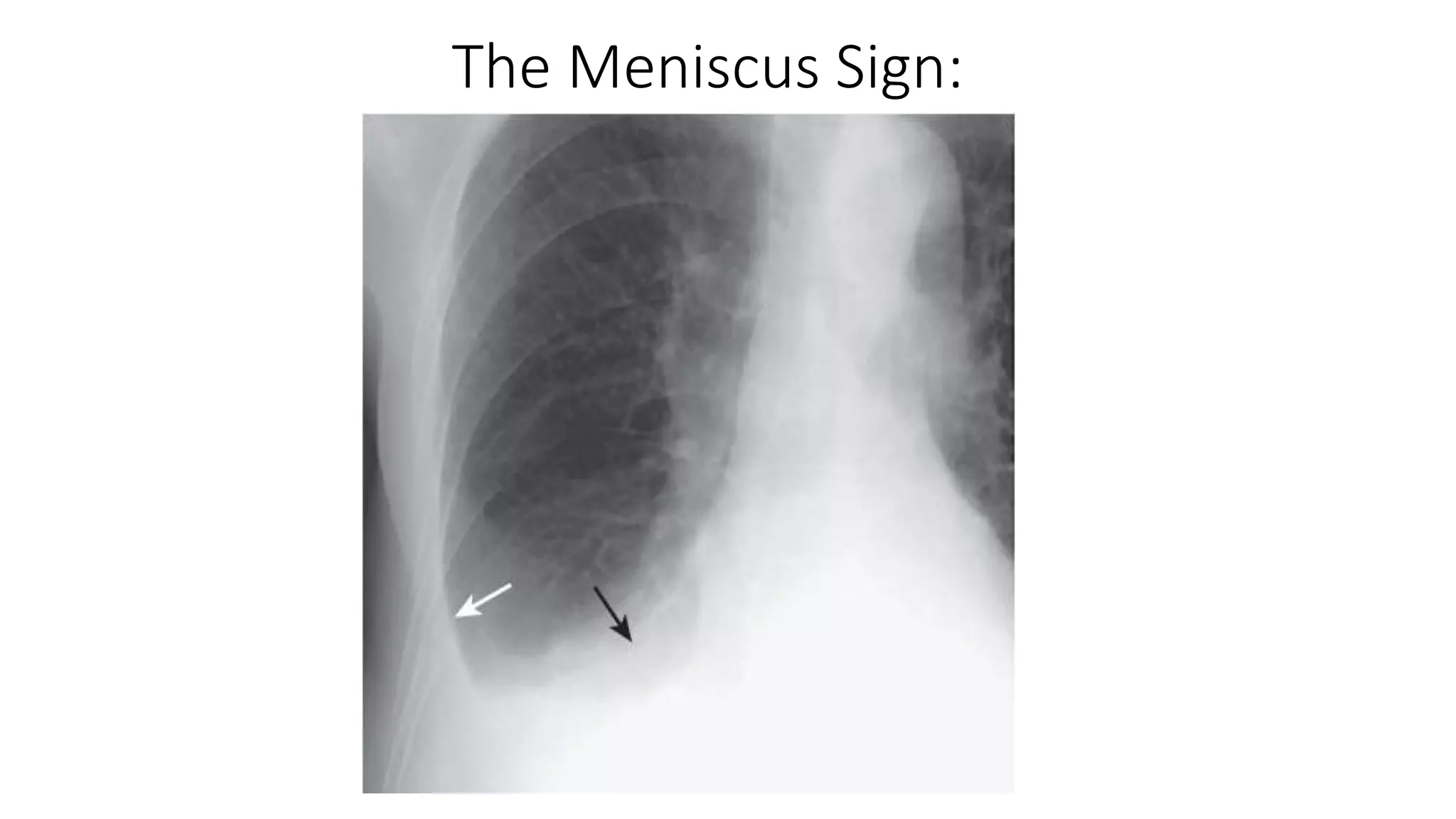 Pleural Effusion & Pneumothorax radiology made simple by Anish Dhakal ...
