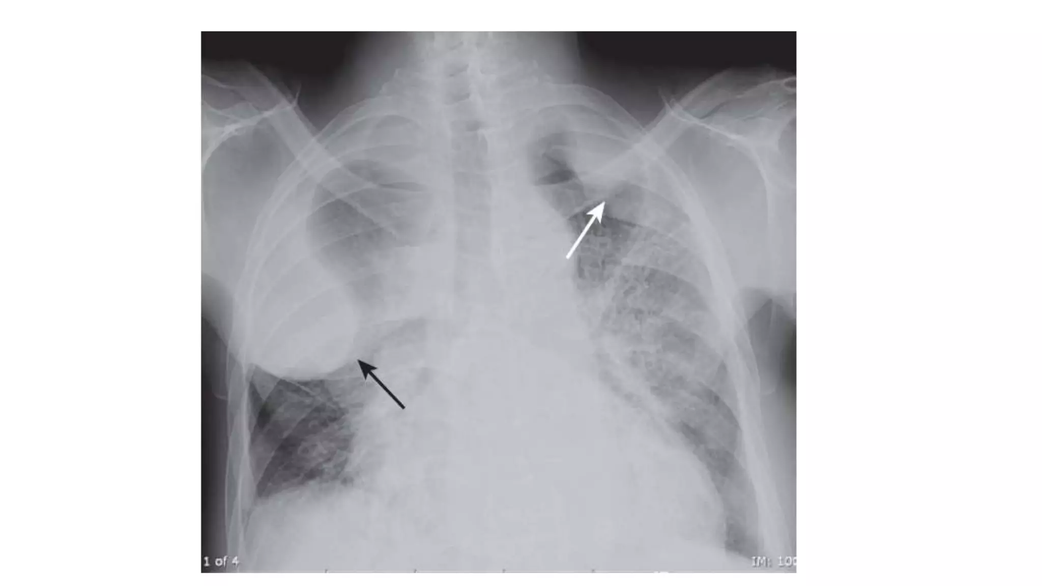 Pleural Effusion & Pneumothorax radiology made simple by Anish Dhakal ...