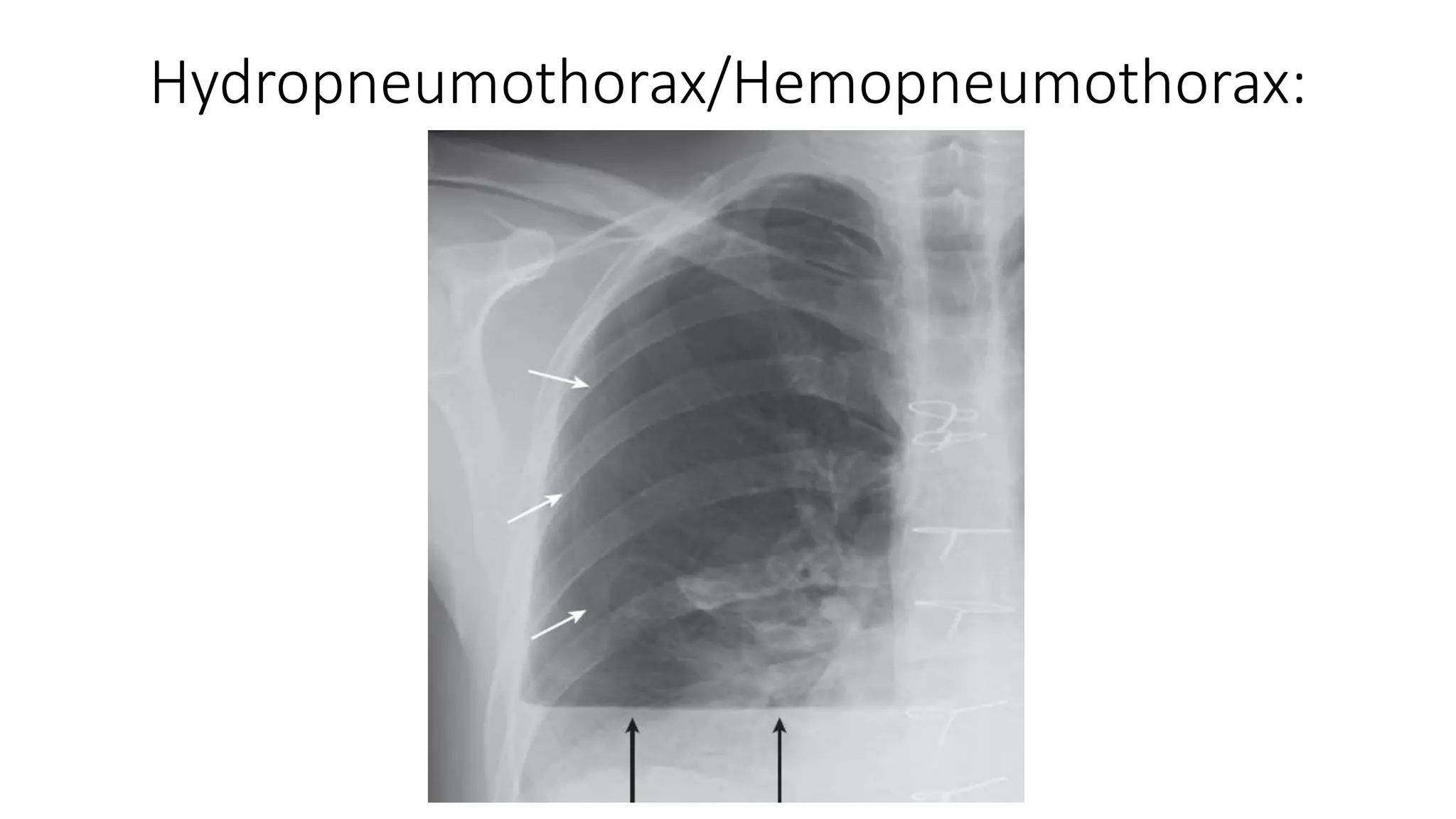 Pleural Effusion & Pneumothorax radiology made simple by Anish Dhakal ...