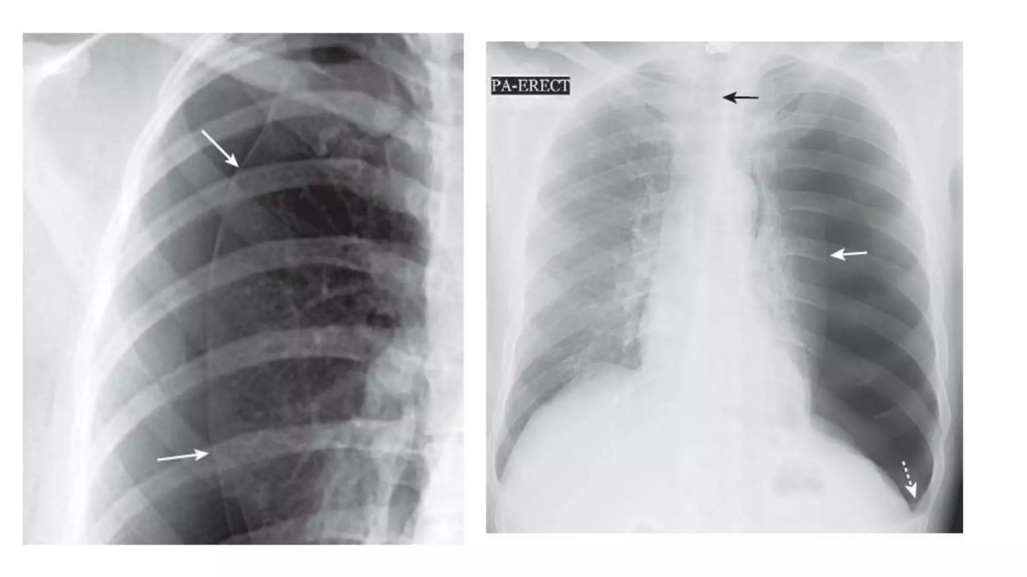 Pleural Effusion & Pneumothorax radiology made simple by Anish Dhakal ...
