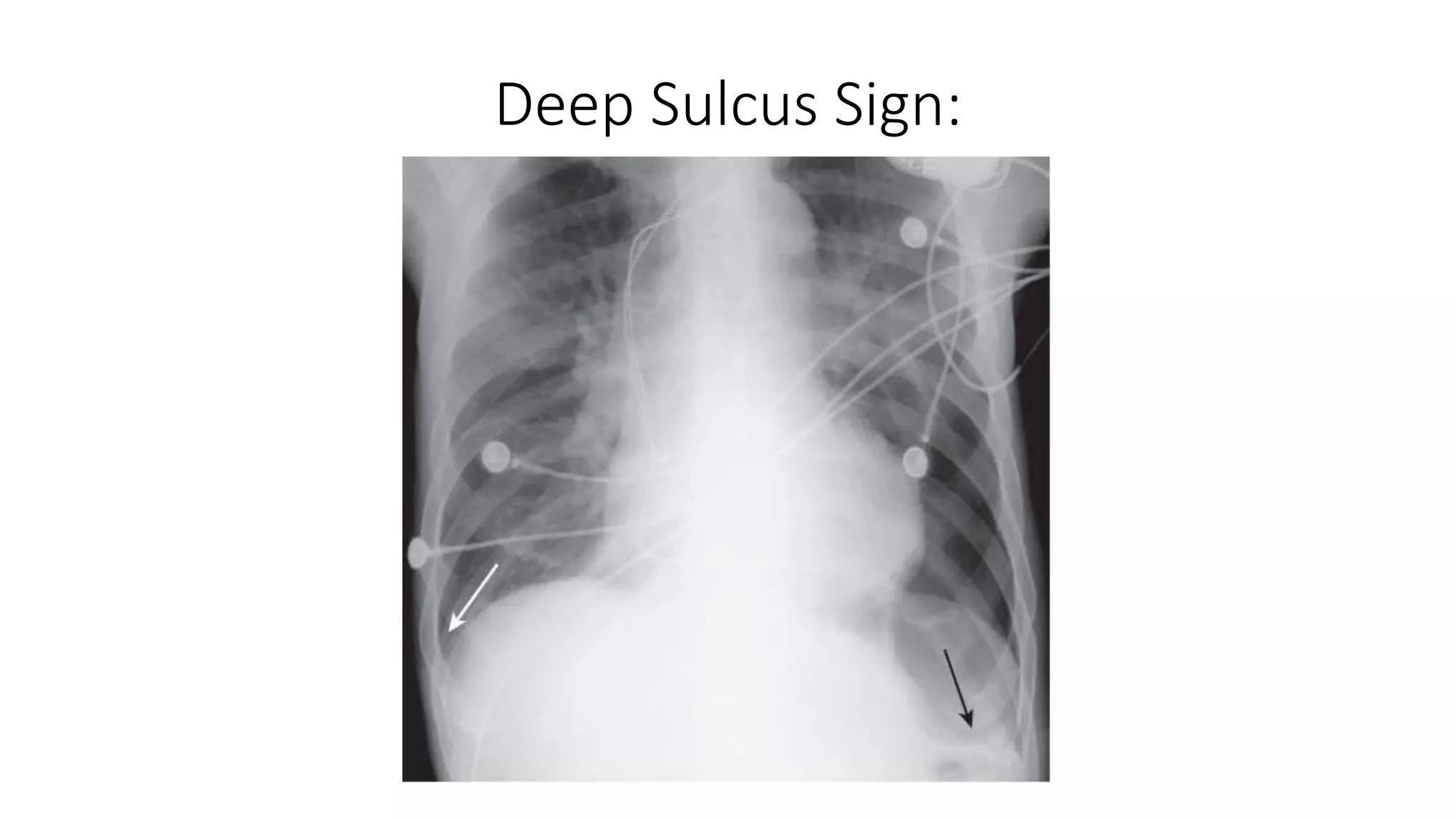 Pleural Effusion & Pneumothorax radiology made simple by Anish Dhakal ...