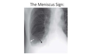 Pleural Effusion & Pneumothorax radiology made simple by Anish Dhakal ...