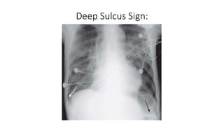 Pleural Effusion & Pneumothorax radiology made simple by Anish Dhakal ...