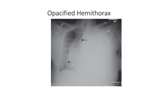 Pleural Effusion & Pneumothorax radiology made simple by Anish Dhakal ...