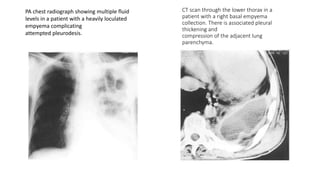 Approach in Pleural pathologies by Dr. Subash Pathak | PPTX