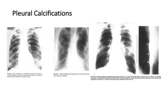 Approach in Pleural pathologies by Dr. Subash Pathak | PPTX