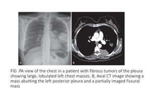 Approach in Pleural pathologies by Dr. Subash Pathak | PPTX
