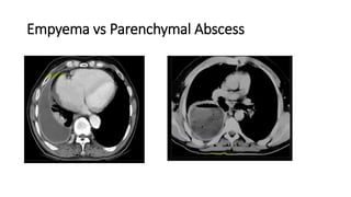 Approach in Pleural pathologies by Dr. Subash Pathak | PPT