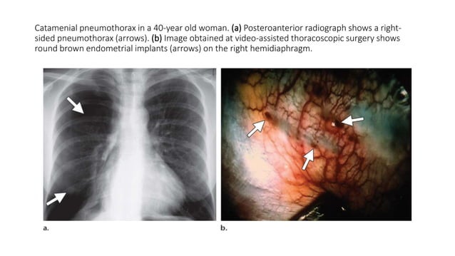 Approach in Pleural pathologies by Dr. Subash Pathak