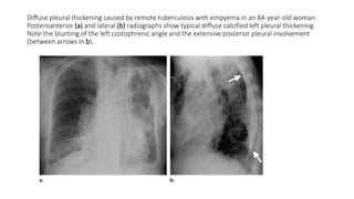 Approach in Pleural pathologies by Dr. Subash Pathak | PPT