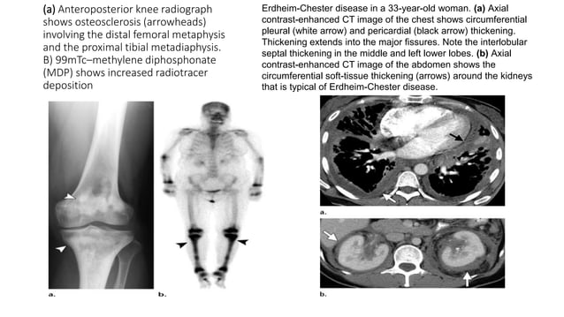 Approach in Pleural pathologies by Dr. Subash Pathak