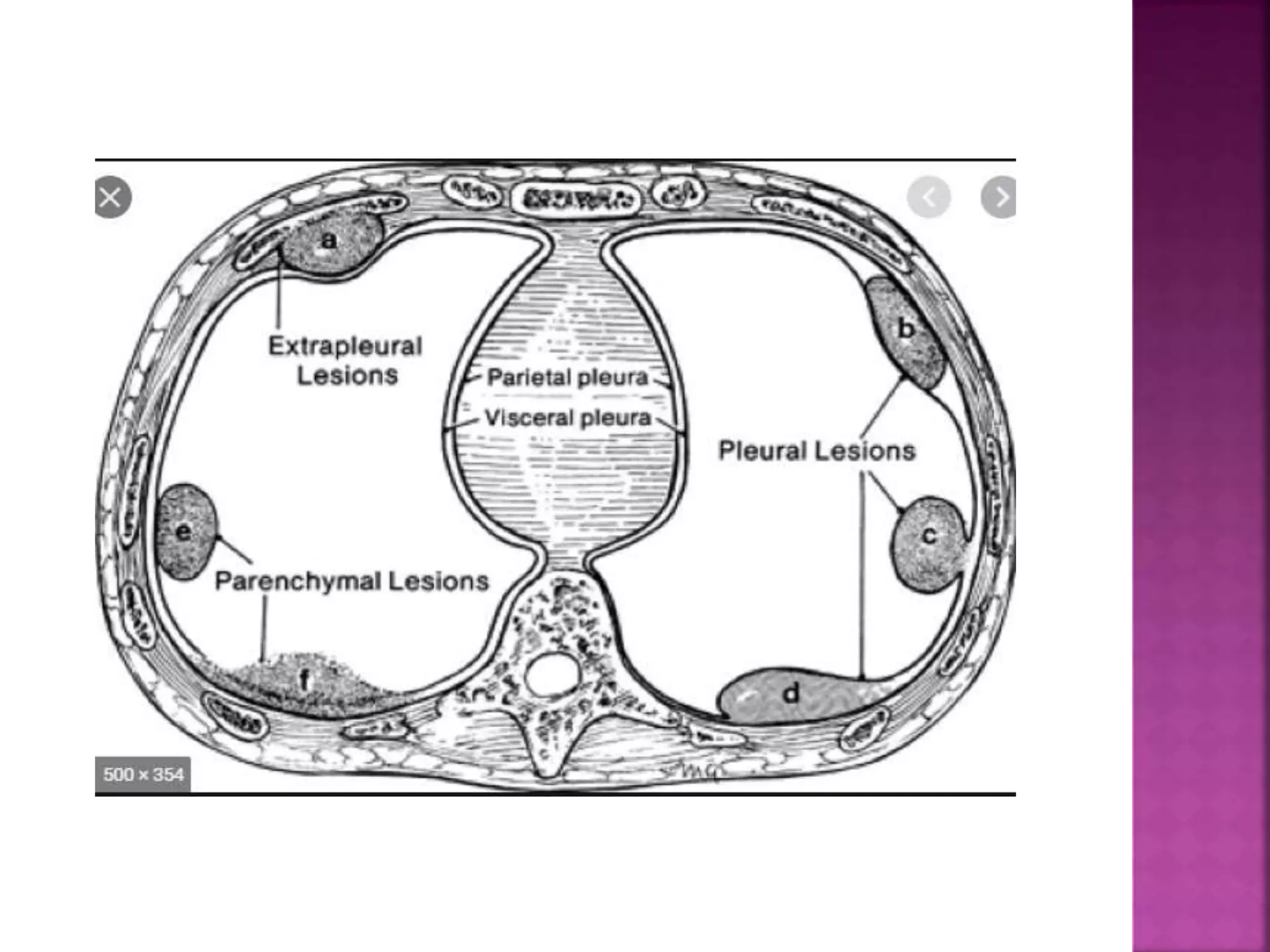 Imaging of Pleural tumors Dr Alekya | PPTX