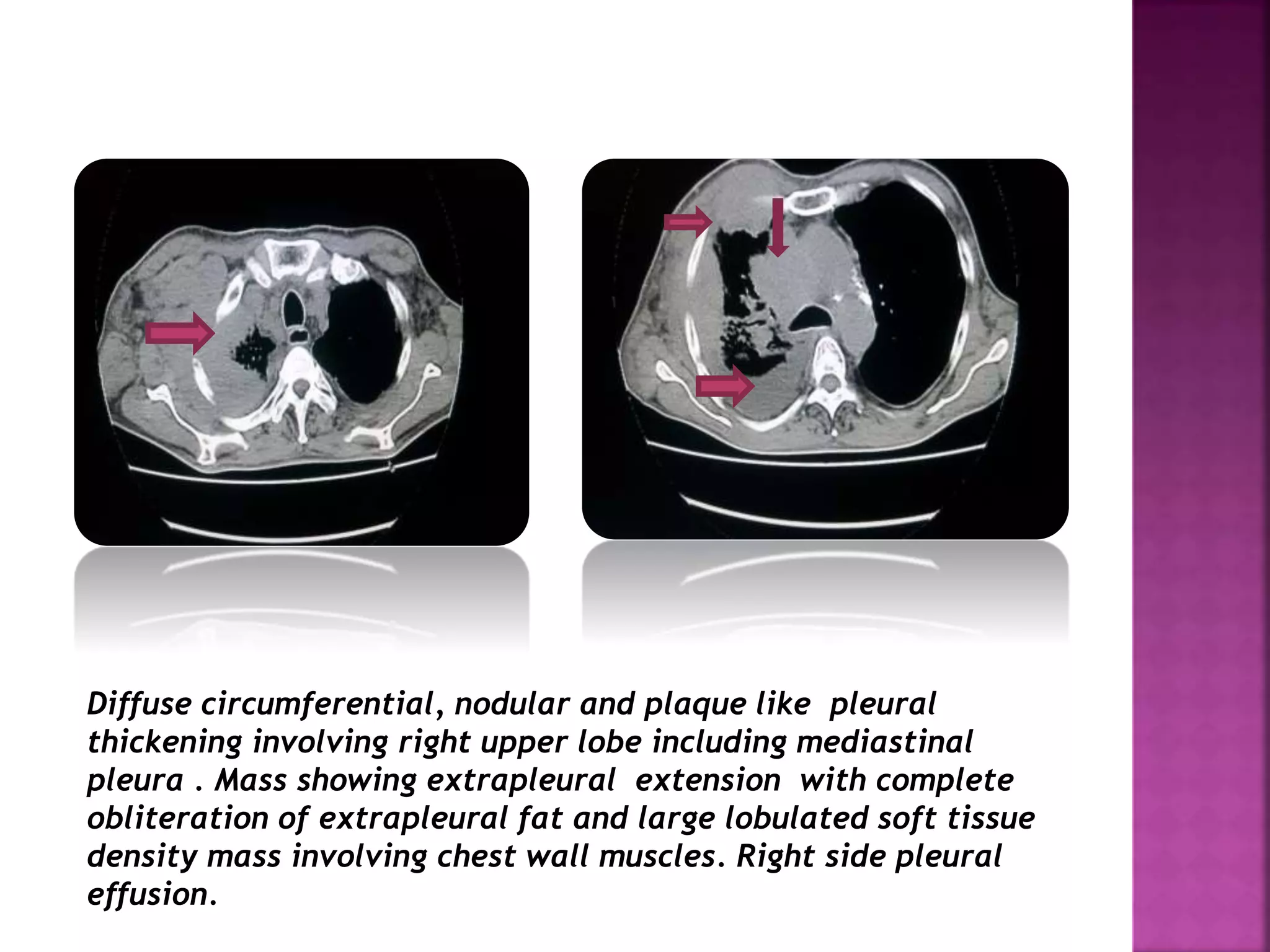 Imaging of Pleural tumors Dr Alekya | PPTX