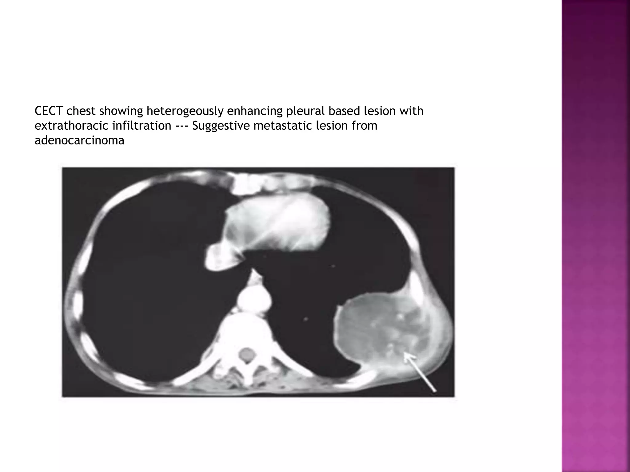 Imaging of Pleural tumors Dr Alekya | PPTX