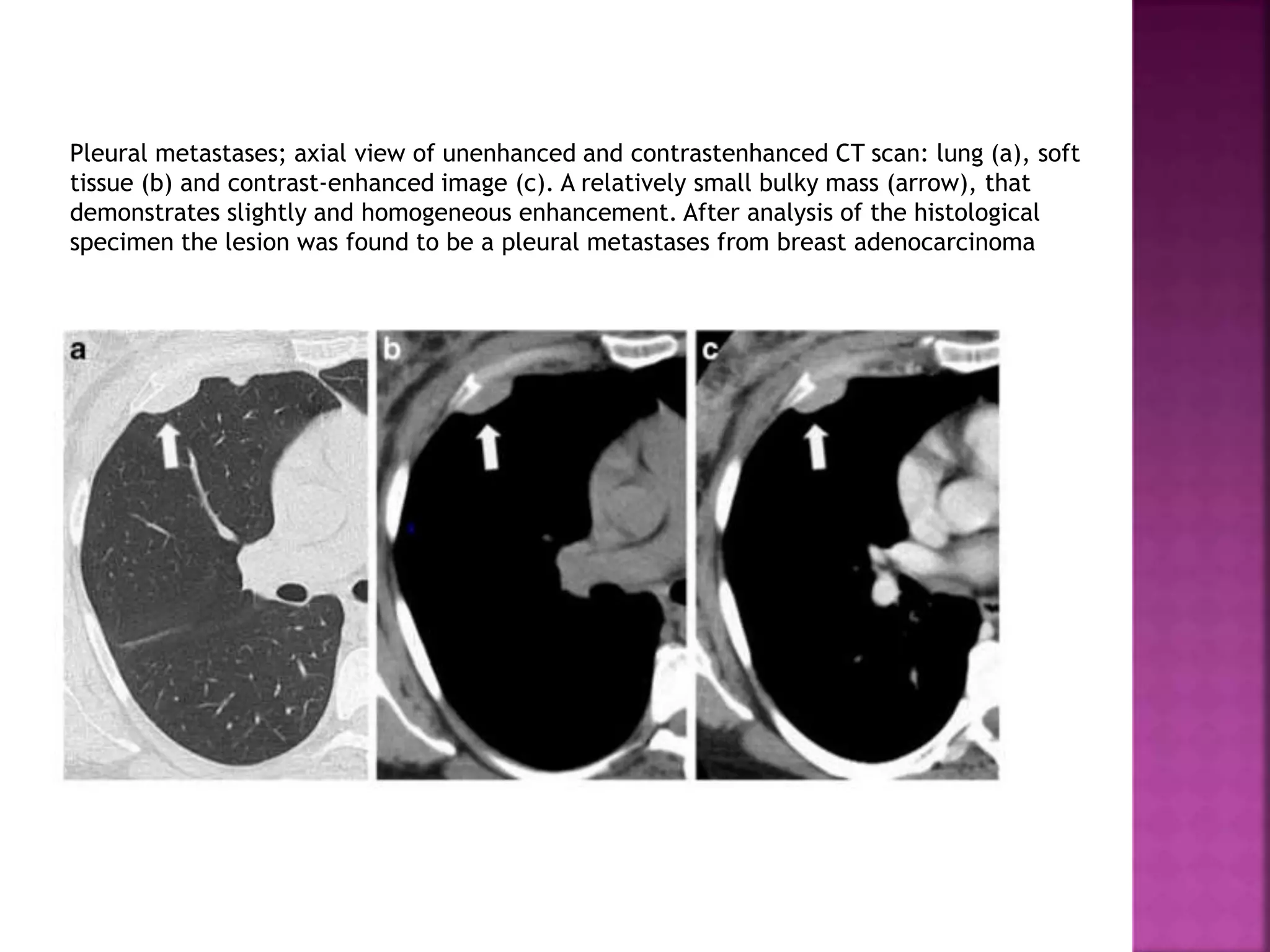 Imaging of Pleural tumors Dr Alekya | PPTX