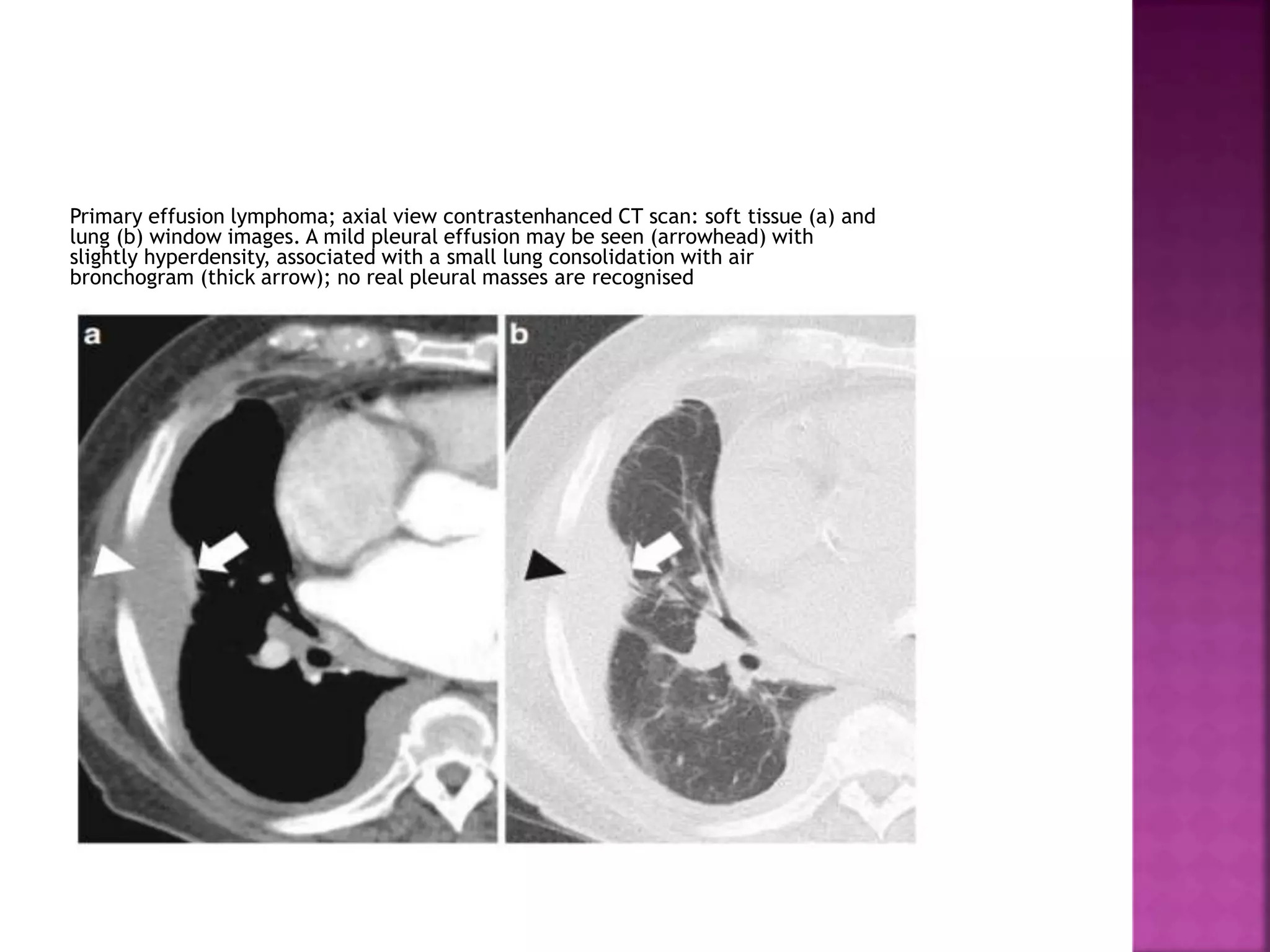 Imaging of Pleural tumors Dr Alekya | PPTX