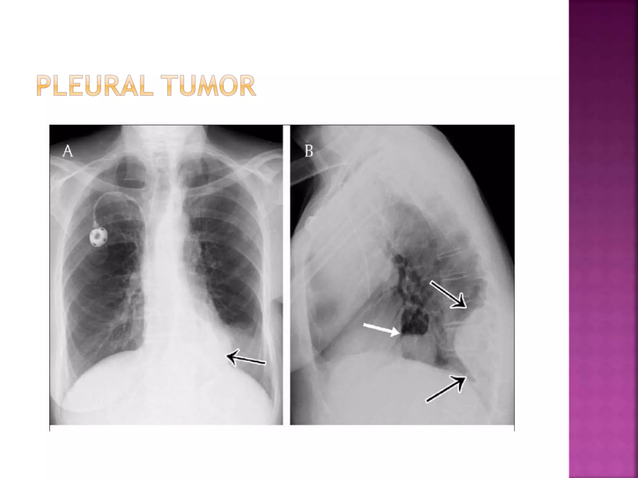 Imaging of Pleural tumors Dr Alekya | PPTX