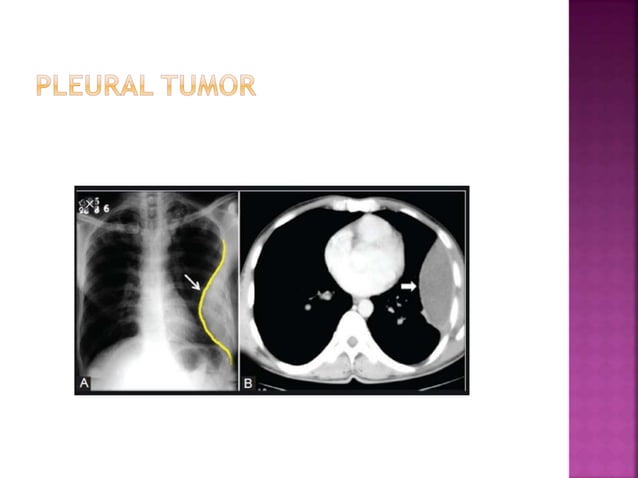 Imaging of Pleural tumors Dr Alekya | PPTX