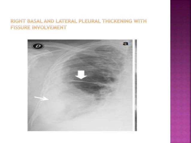 Imaging of Pleural tumors Dr Alekya | PPTX