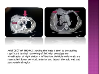 Imaging of Pleural tumors Dr Alekya | PPTX