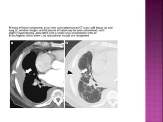 Imaging of Pleural tumors Dr Alekya | PPTX
