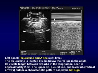 Ultrasound Guided Pleural Procedures | PPTX