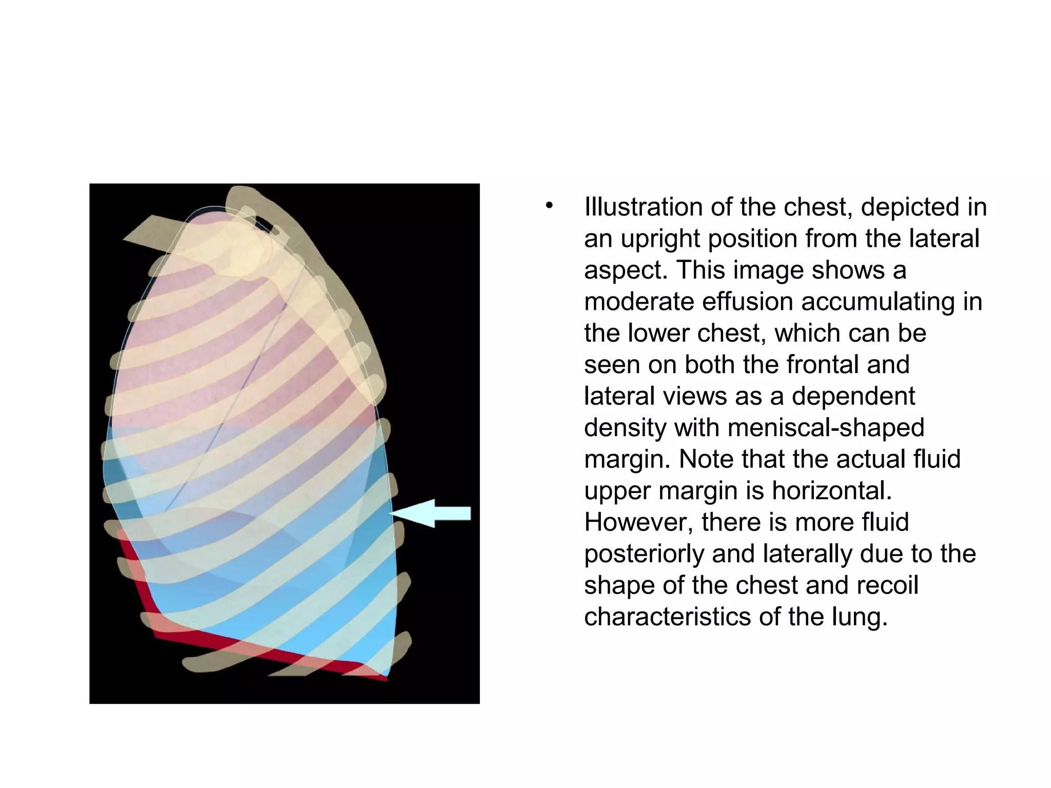Pleural diseases chest radiology part1 | PPT